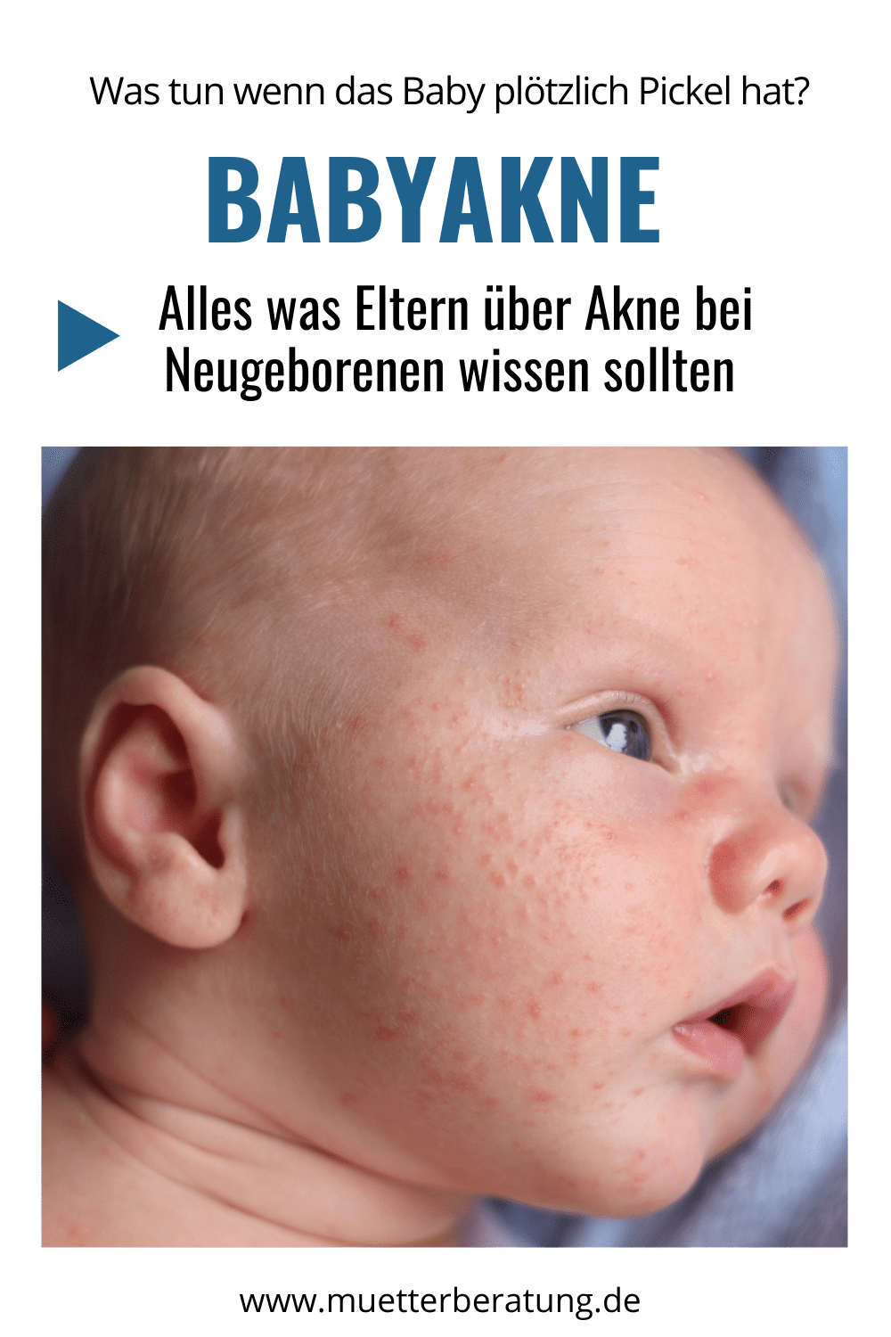 Neugeborenakne: Ursache & was hilft bei Babyakne?